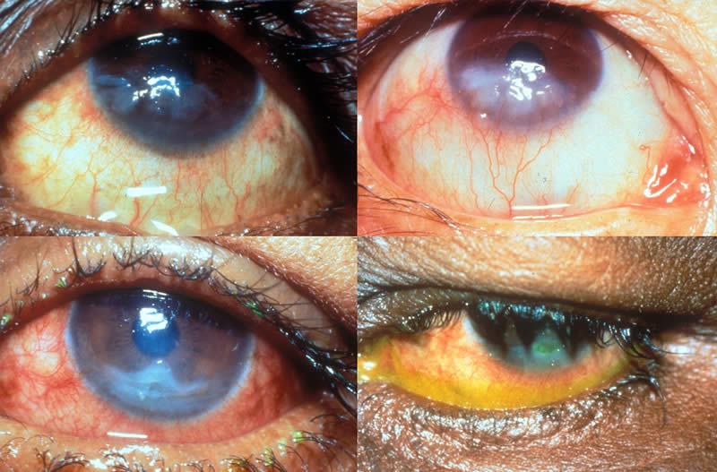 Community Eye Health Journal » Leprosy and the eye teaching set. Full text