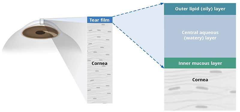 Community Eye Health Journal » Dry eye disease: an introduction