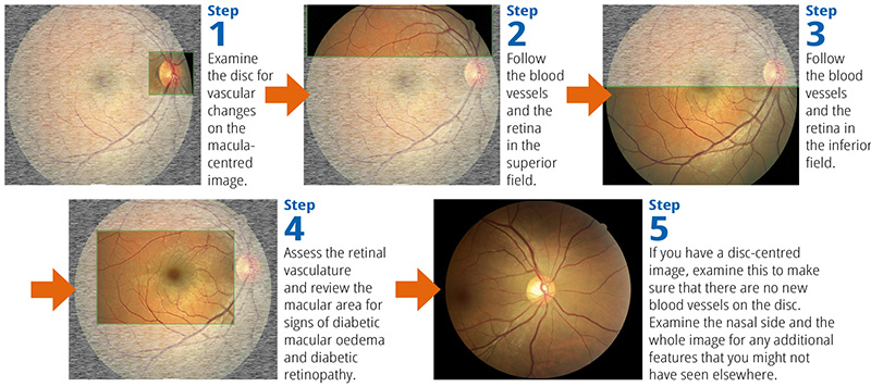 Community Eye Health Journal » Grading images for diabetic retinopathy ...
