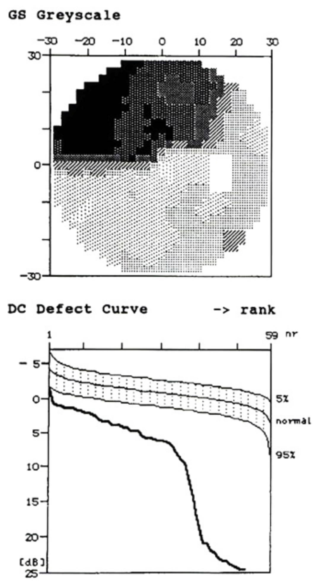 Community Eye Health Journal » Visual fields interpretation in glaucoma ...