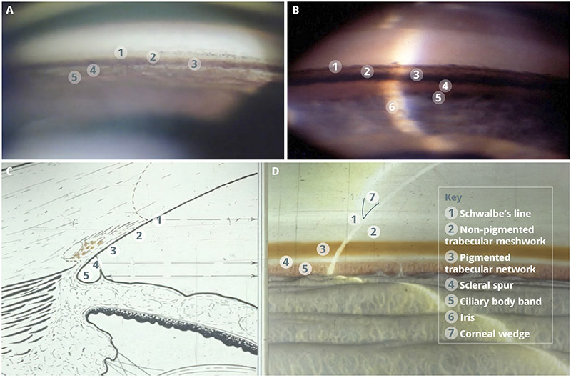 Community Eye Health Journal » Gonioscopy skills and techniques