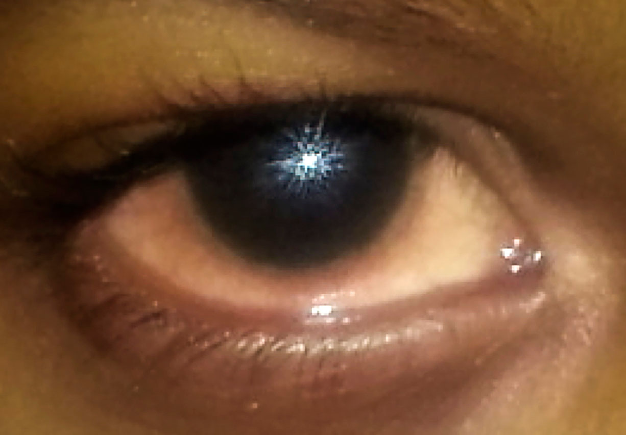 Allergic Conjunctivitis Cobblestone