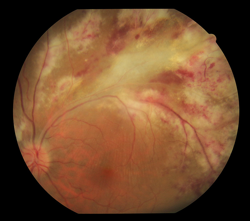 Community Eye Health Journal » Cytomegalovirus: clinical features and ...