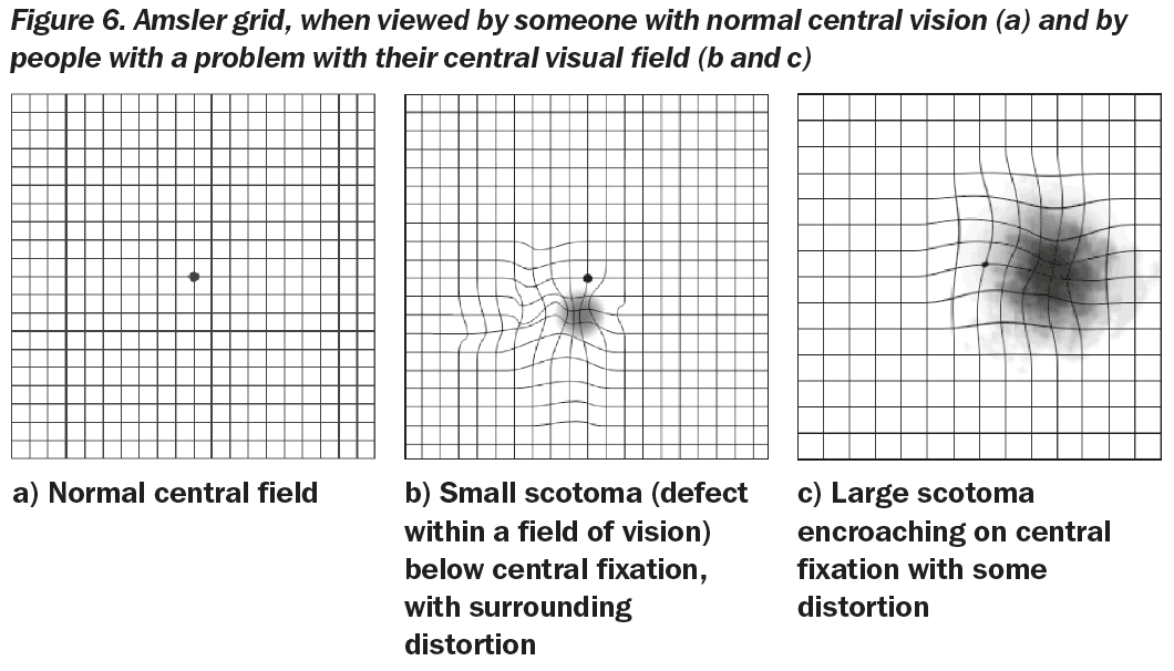 Community Eye Health Journal » Visual field testing for glaucoma – a ...