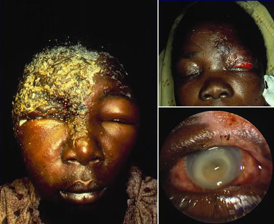 Community Eye Health Journal » Herpes zoster ophthalmicus in HIV/AIDS