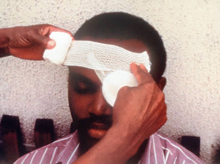 Community Eye Health Journal » How to apply an eye pad, shield, and bandage