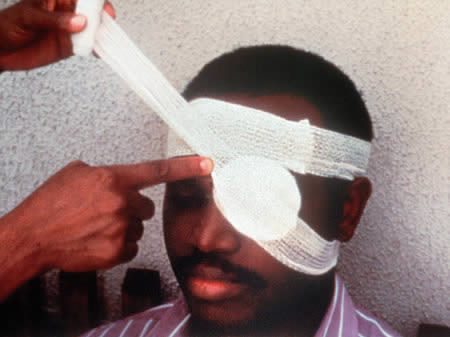 Community Eye Health Journal » How to apply an eye pad, shield, and bandage