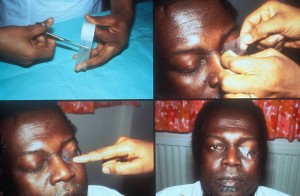 Community Eye Health Journal » Taping an eyelid closed