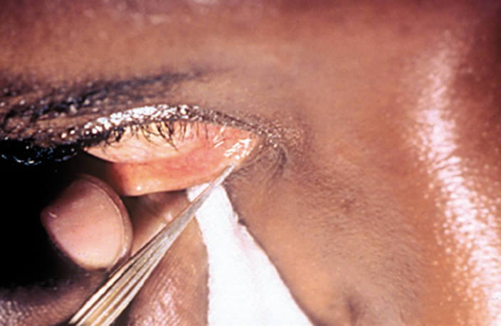 Community Eye Health Journal » Lacrimal syringing
