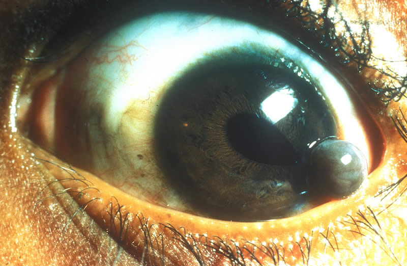 Community Eye Health Journal » Eye in primary health care teaching set ...