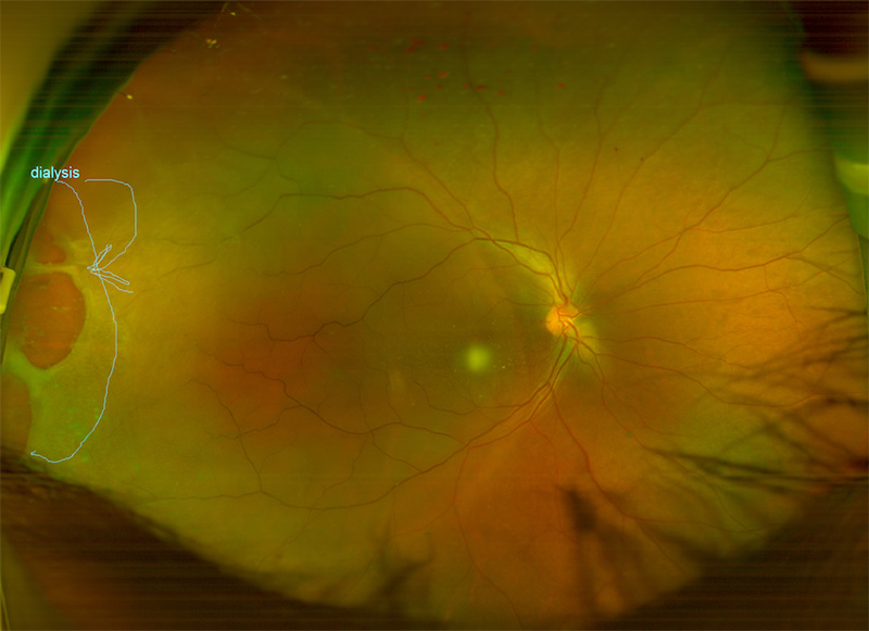 Community Eye Health Journal » Recent advances in retinal imaging and ...