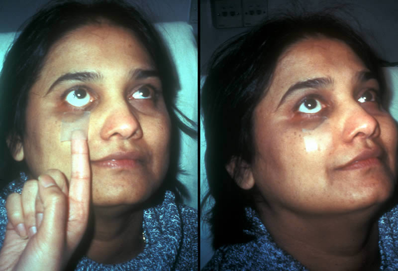 Community Eye Health Journal » Tape correction for lower eyelid entropion