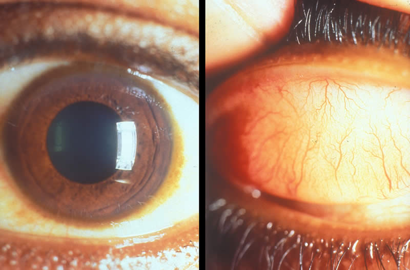 Community Eye Health Journal » Eye in primary health care teaching set ...