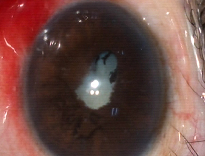 Community Eye Health Journal » Managing cataract surgery in patients ...