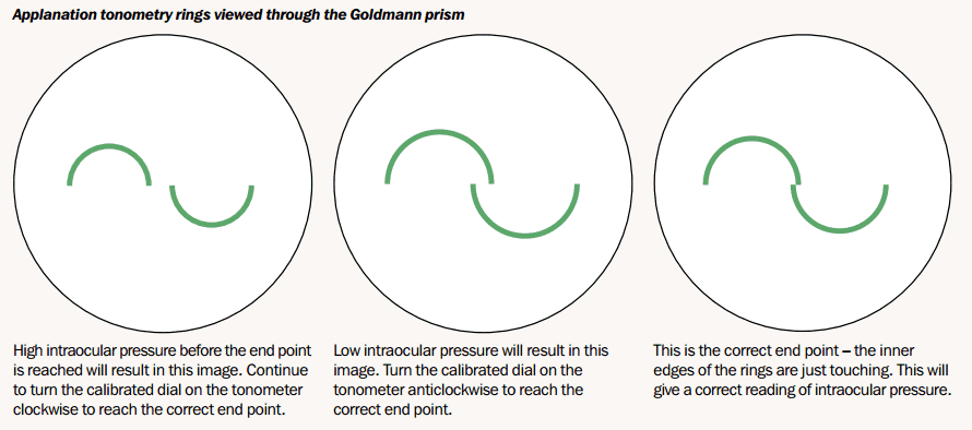Community Eye Health Journal » How to measure intraocular pressure ...