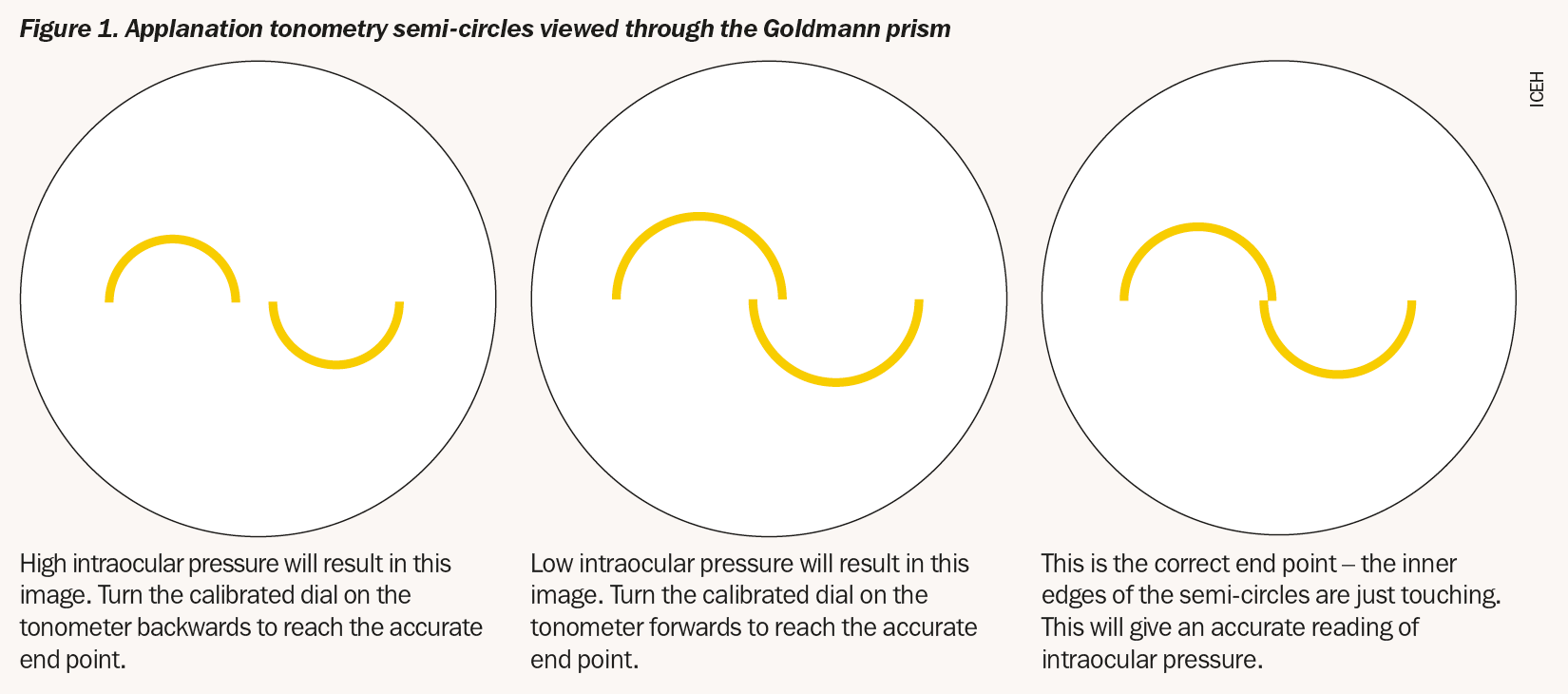 Community Eye Health Journal » How to measure intraocular pressure ...