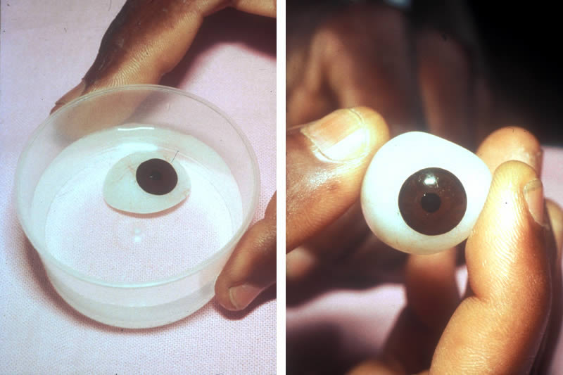 Community Eye Health Journal » Management of an eye prosthesis or conformer