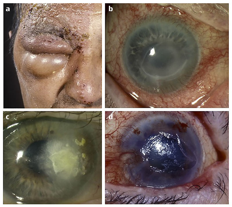 Revue de Santé Oculaire Communautaire » Prise en charge du zona ophtalmique