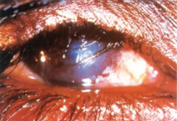 Community Eye Health Journal » At a glance: the core neglected tropical ...